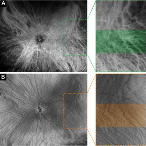 Correlation Between Vortex Vein Drainage Areas And Identification Of