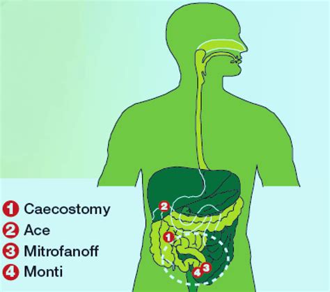 What Is A Mace Procedure At Harold Spence Blog