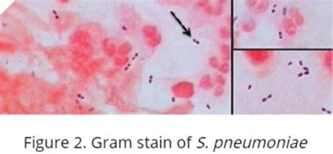 Streptococcus Pneumoniae Gram Stain Csf