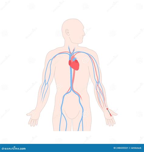Arterial Line Catheter Placed In The Radial Artery Cartoon Vector