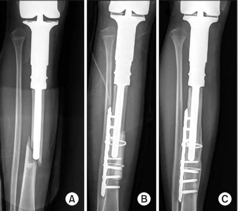 A Anteroposterior Radiograph Of The Right Tibia Showing Fracture At Download Scientific