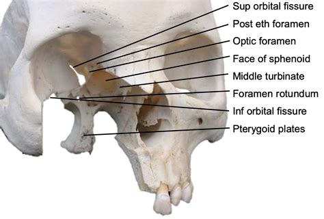 131 Total Maxillectomy And Orbital Exenteration Medicine Libretexts