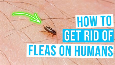 How to GET RID OF FLEAS ON HUMANS - YouTube