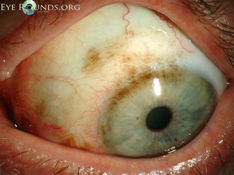 Ocular Surface Tumors
