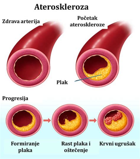Razumevanje Ateroskleroze Šta Je I šta Je Uzrokuje Vaša Kuća Zdravlja