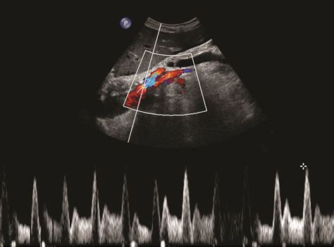 Chronic Mesenteric Ischemia Mesenteric Artery Duplex Sonography And