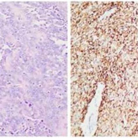 Left The Mass Specimen Showed Proliferative Intrauterine Endometrium Download Scientific