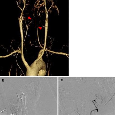 CT Angiogram A And Cerebral Angiogram Showing Left Vertebral Artery