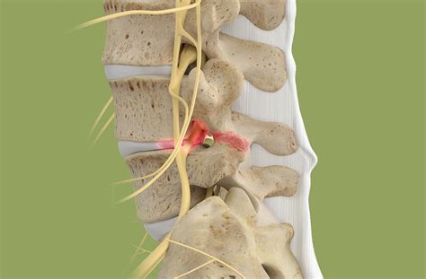DIAMPATIENT | Companion Spine