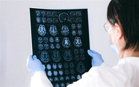 The Glymphatic Systems Potential Link To Alzheimers Esurgi