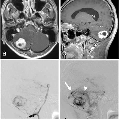 Axial A And Sagittal B T1 Weighted Gadolinium Enhanced Magnetic