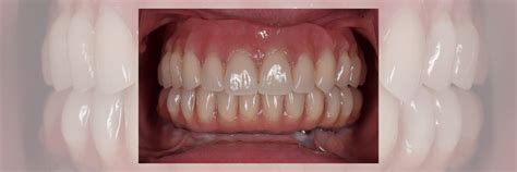 Socket Shield Therapy When Where And How Iti Blog