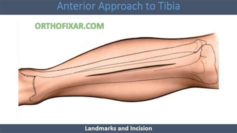 Anterior Approach To Tibia Easily Explained Orthofixar