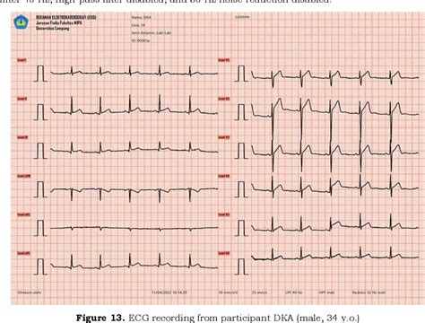 Figure 1 From Design Of Computer Based 12 Lead Ecg Using Stm32f401 Microcontroller Semantic