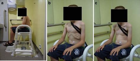 Dysfunctional Voiding The Importance Of Non Invasive Urodynamics In