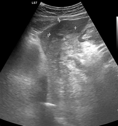 building an ai system to detect liver cancer