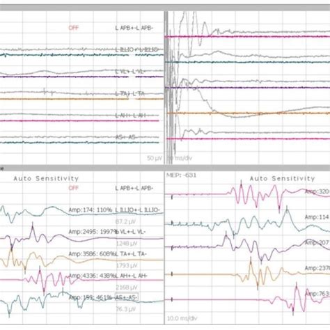 Image Showing Intraoperative Mep Monitoring Screenshots Download