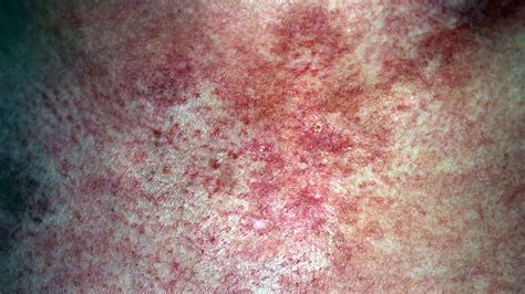 Myositis Skin Rash