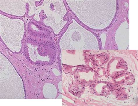Proliferative And Non Proliferative Breast Dx Not Cancers Flashcards