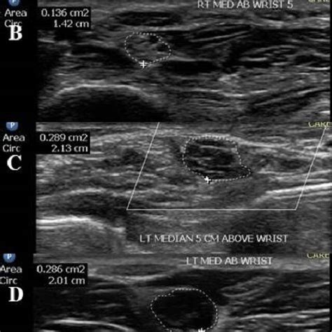 Fascicular Grading With Examples Grade 0 A Grade 1 B Grade 2 C Download Scientific