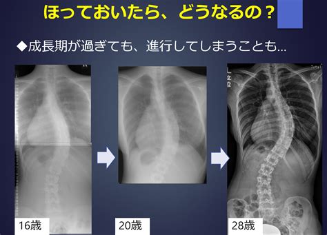 思春期特発性側弯症の頻度と自然経過のお話し石川県小松市 牧野整形外科医院脊椎外科腰痛肩こり神経痛