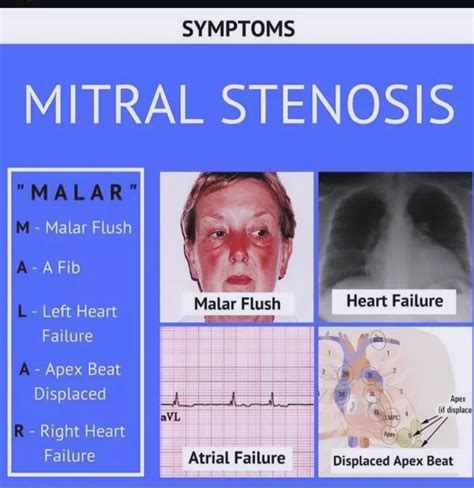 Soltani Far Mitral Valve Stenosis Mitral Stenosis Is Narrowing Of The Mitral Orifice That
