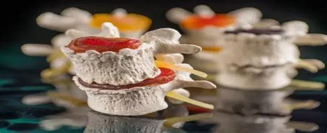 What Determines Workers Comp Herniated Disc Settlement