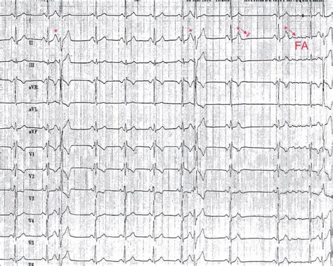 Mecanismos Electrofisiológicos Y Diagnóstico De La Fibrilación