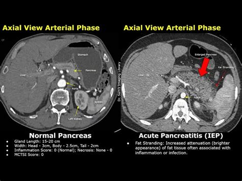 Free Video Ct Normal Pancreas Vs Acute Pancreatitis Balthazar Modified Ct Severity Index