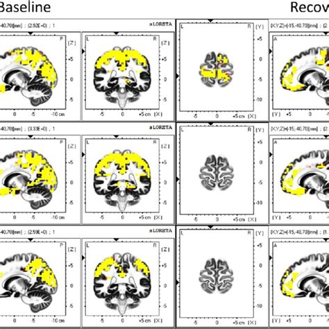 Statistical Assessment Of The Temporal Evolution Of The Cortical