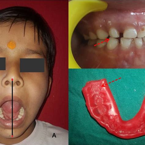 Pdf Preventive Orthodontic Approach For Functional Mandibular Shift