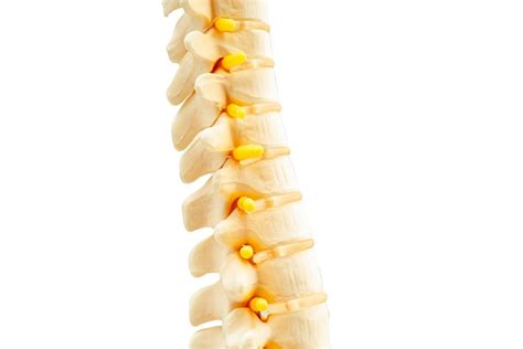 Premium Photo Lumbar Spine Displaced Herniated Disc Fragment Spinal