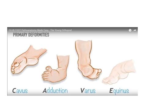 Lower Limb Deformitiespptx Death Injury Or Military Conflict