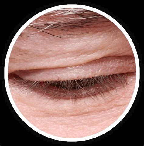 Demodex Blepharitis Xdemvy® Lotilaner Ophthalmic Solution 025