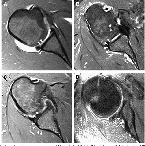 Figure 4 From Normal And Variant Anatomy Of The Shoulder On Mri