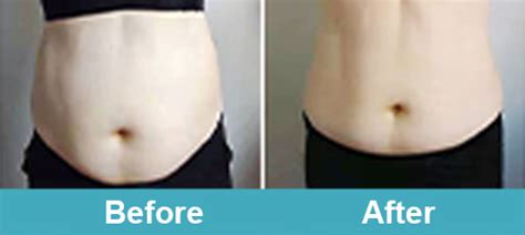Infrared Pressotherapy Lymphatic Drainage Massage Prettylasers