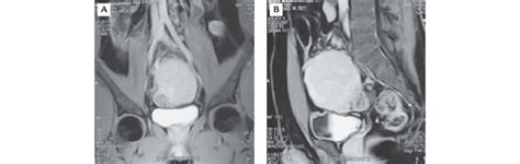 A B Magnetic Resonance Imaging Revealed A Large Vascular Mass 7 Cm