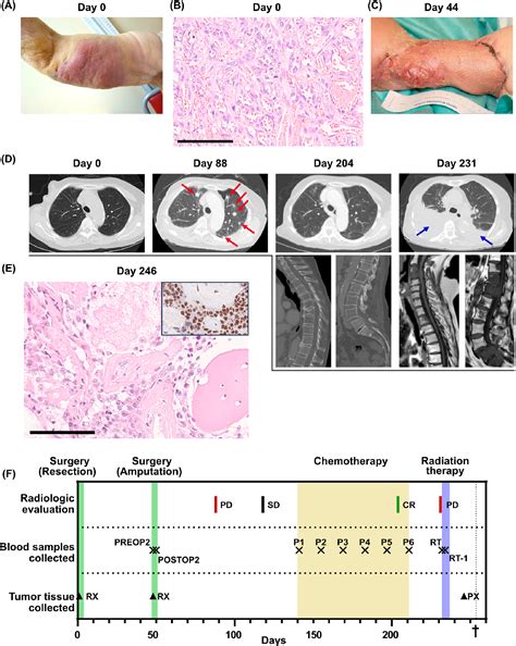 Figure 1 From Treatment Monitoring Of A Patient With Synchronous Metastatic Angiosarcoma And