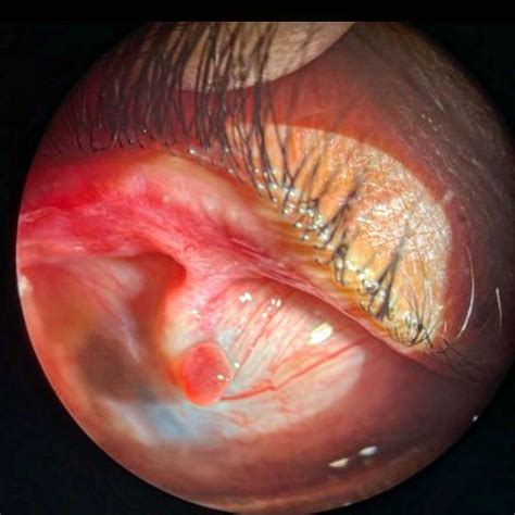 Pyogenic Granuloma Eye Treatment