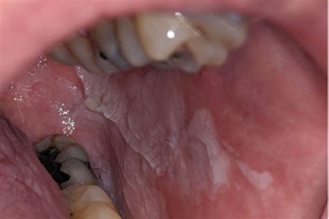 Leukoplakia Buccal Mucosa