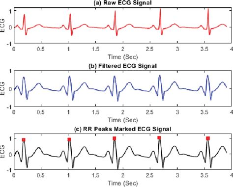Automatic Detection Of Sleep Apnea From Single Lead Ecg Signal Using