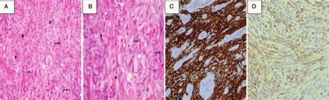 A D Resection Specimens Of Gastrointestinal Stromal Tumor GIST