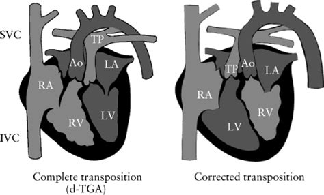 Congenitally Corrected Transposition Of The Great Arteries Clues For