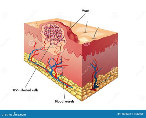 Wart Stock Vector Image Of Immune Blood Cute Anus 42533231