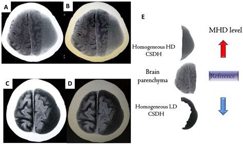Subdural Hematoma