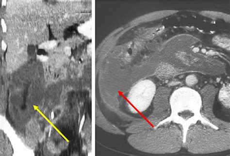 14 Mimics Of Appendicitis