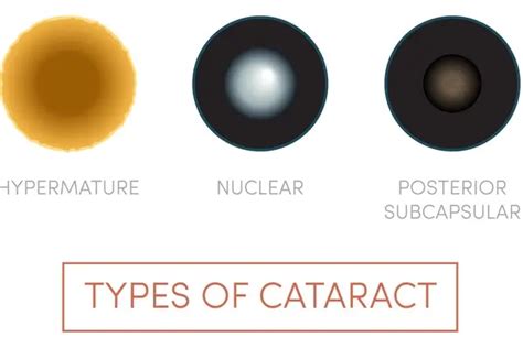 The Different Types Of Cataracts Practice Plus Group