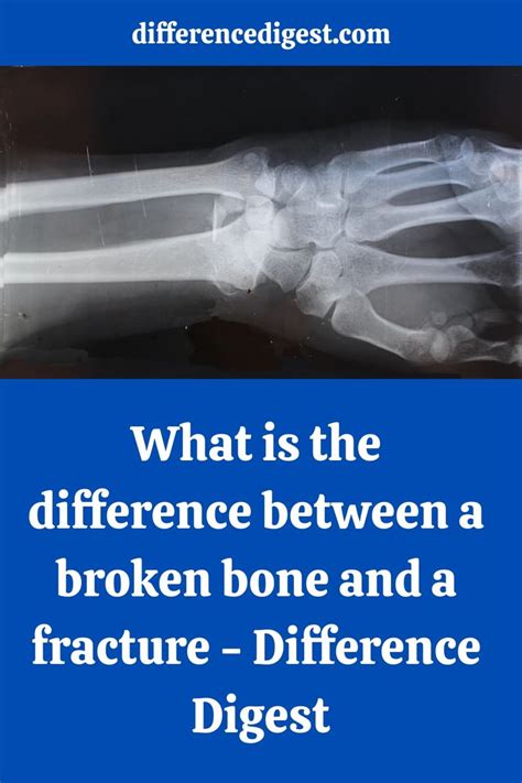 Difference Between Broken Bone And Fracture