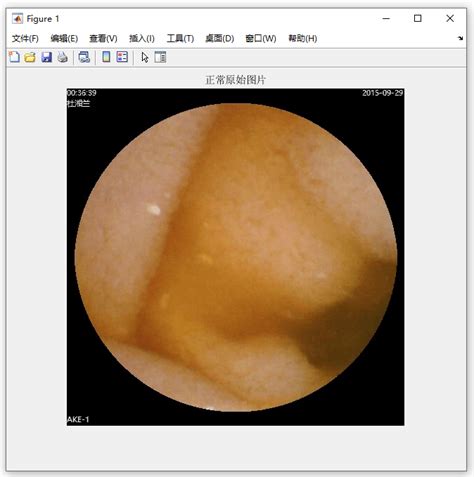 基于matlab病灶图片进行gabor小波纹理特征提取及损伤分类 索炜达 猿创