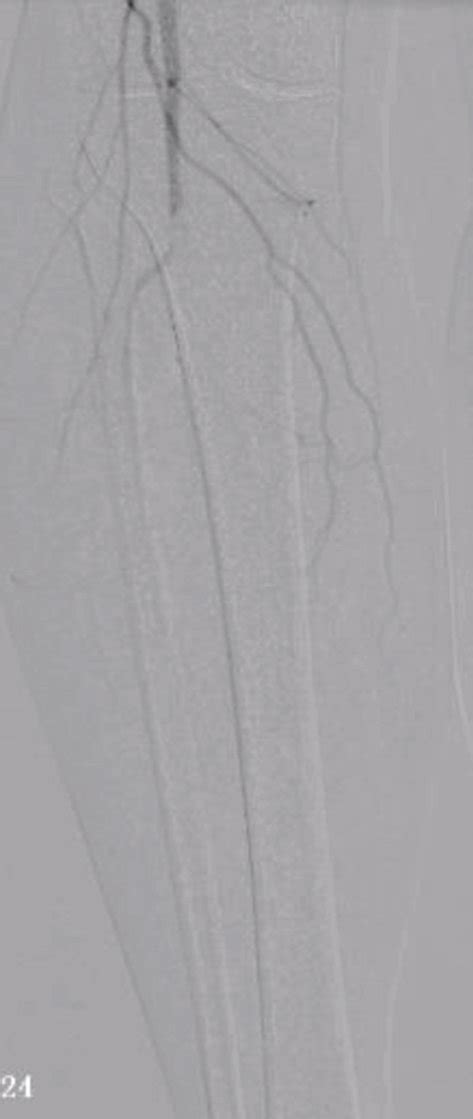 bracket legend note a angiography shows acute below the knee artery